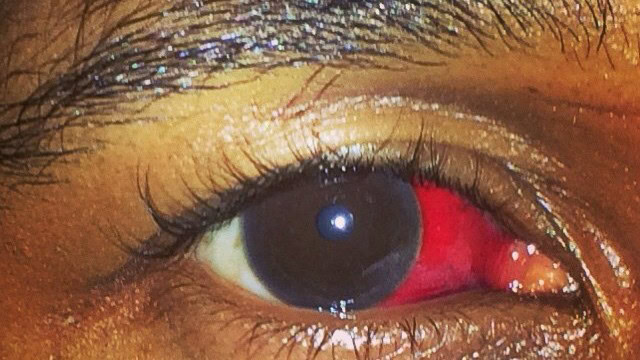 Usher Posts Picture Of His Red Eye Injury From Fighting At A New Year’s ...